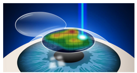 Lasik Surgery in New York City | New York Ophthalmology